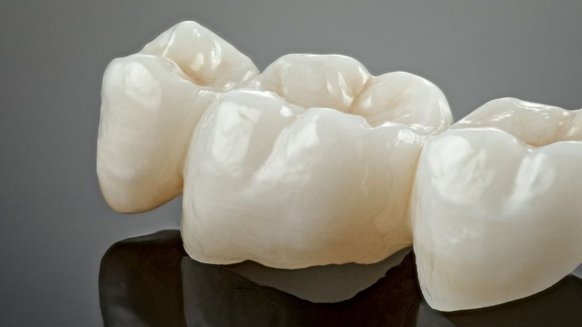 All-on-4 Zirconia: Premium Fixed Full-Arch Teeth on Implants